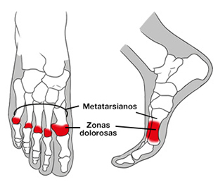 Metatarsalgia e dor na sola do pé