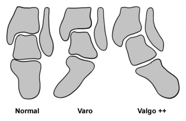 Tornozelo inchado e dor ao pisar: o que pode ser e soluções