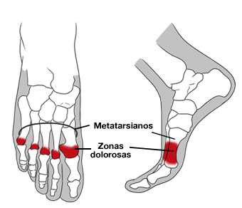 Dor no 2º ao 4º metatarso – embaixo dos dedos do pé