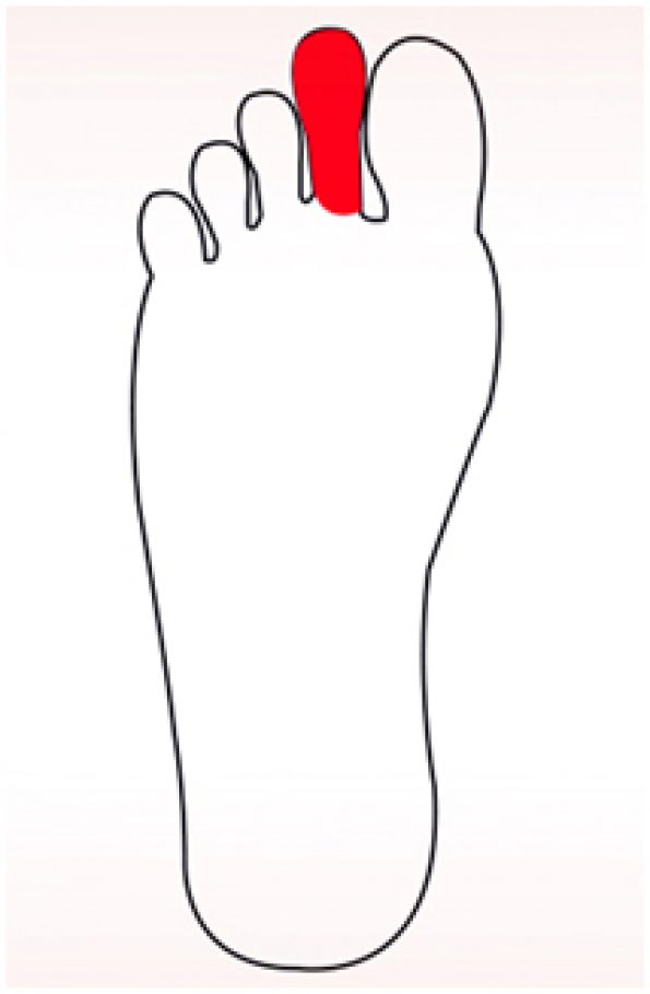Palmilha para Dedo de Morton, Elimine as Dores nos Pés
