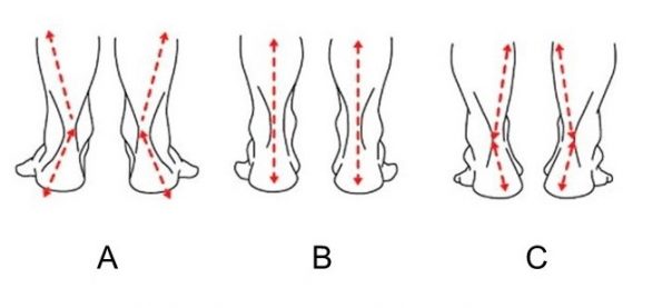 Tipos de pisada: quais a diferenças? | Pés Sem Dor