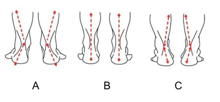 Tipos de pisada: quais a diferenças? | Pés Sem Dor