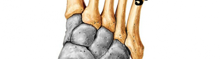 Problemas no quinto metatarso | Pés Sem Dor