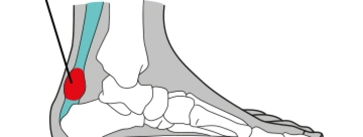 Dor Na Tendinopatia De Aquiles
