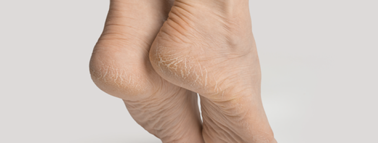 Pé rachado: causas e tratamentos | Pés Sem Dor