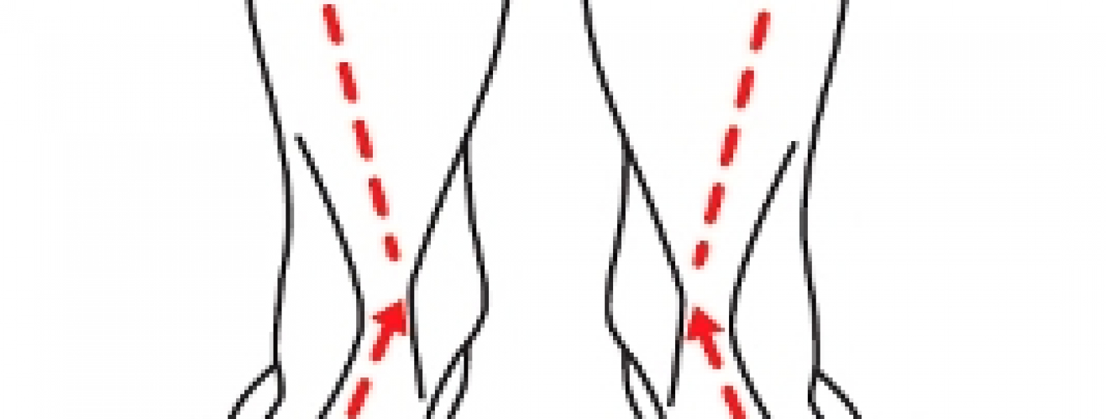 Tipos de pisada: exercícios e o tênis | Pés Sem Dor